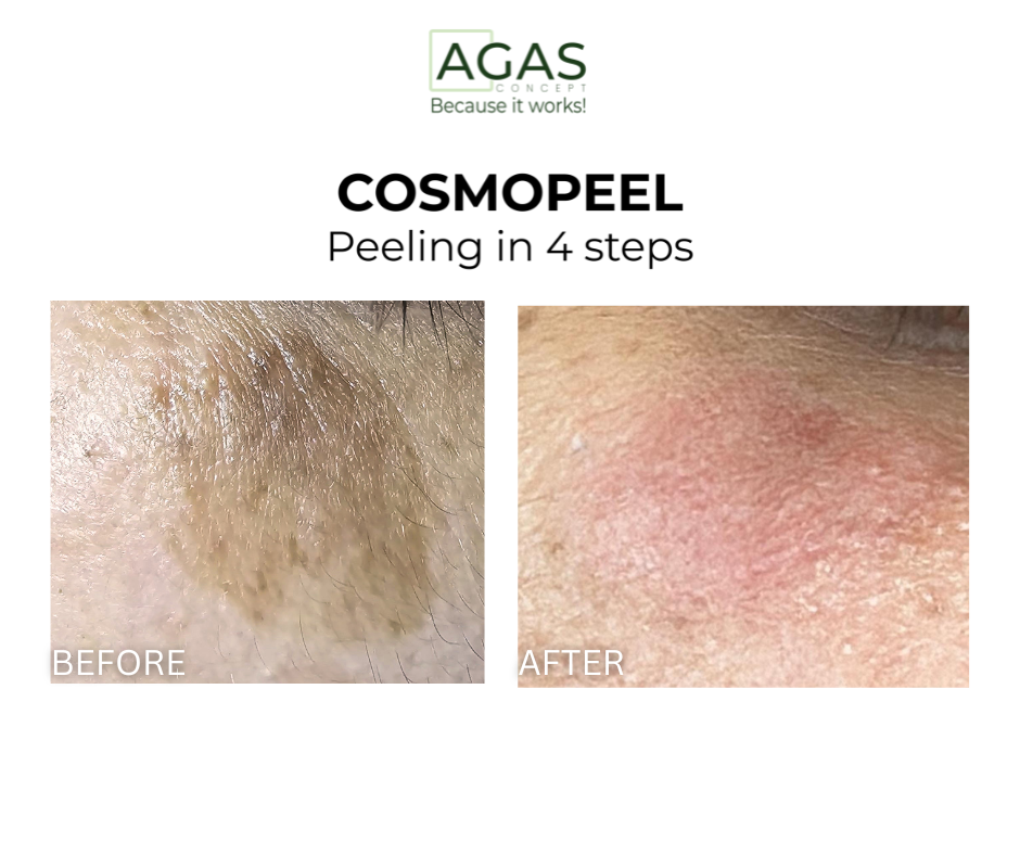 Cosmopeel - AGAS Concept